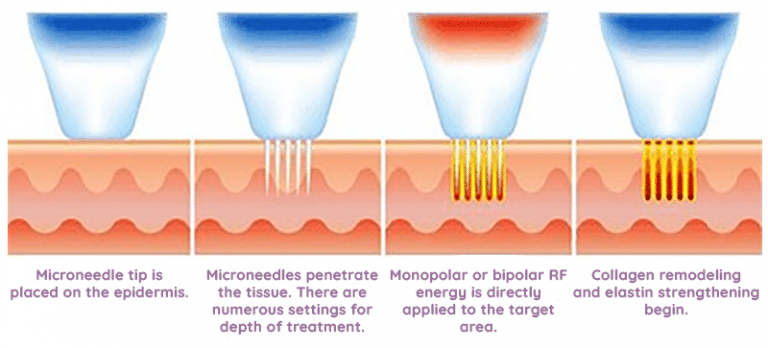 Potenza™ ~ RF Microneedling ~ Affordable Beauty