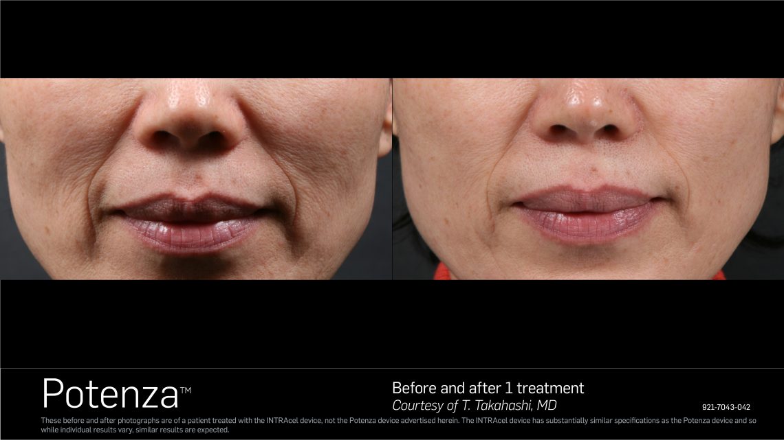 Potenza™ ~ RF Microneedling ~ Affordable Beauty